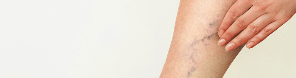 What Are Varicose Veins and How Do They Affect Vascular Health? – Texas ...